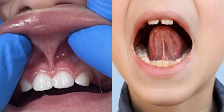 ¿Cuándo llevar a mi pequeño para una evaluación de frenillo labial o ...